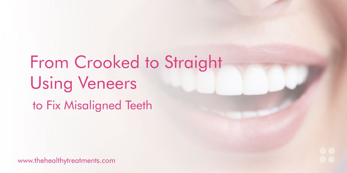 Using Veneers to Fix Misaligned Teeth - Elija un cirujano, consulte a ...